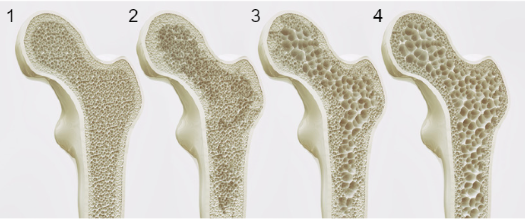 Osteopenie (verlaagde botmineraaldichtheid) | St. Antonius Ziekenhuis