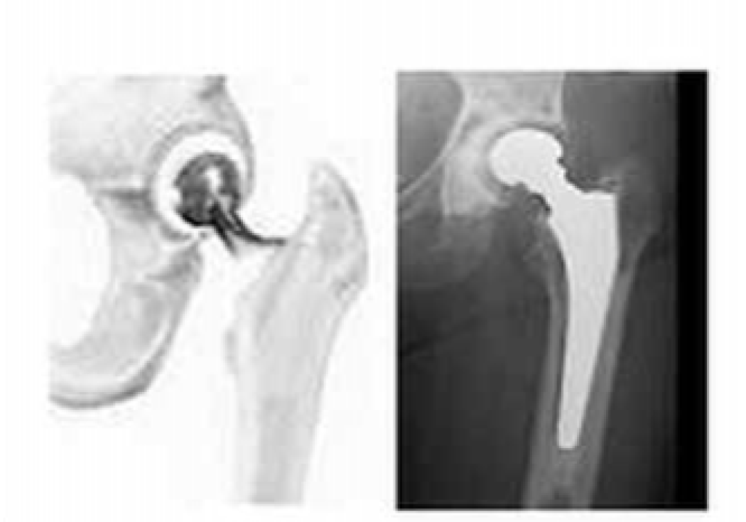Heupprothese | St. Antonius Ziekenhuis