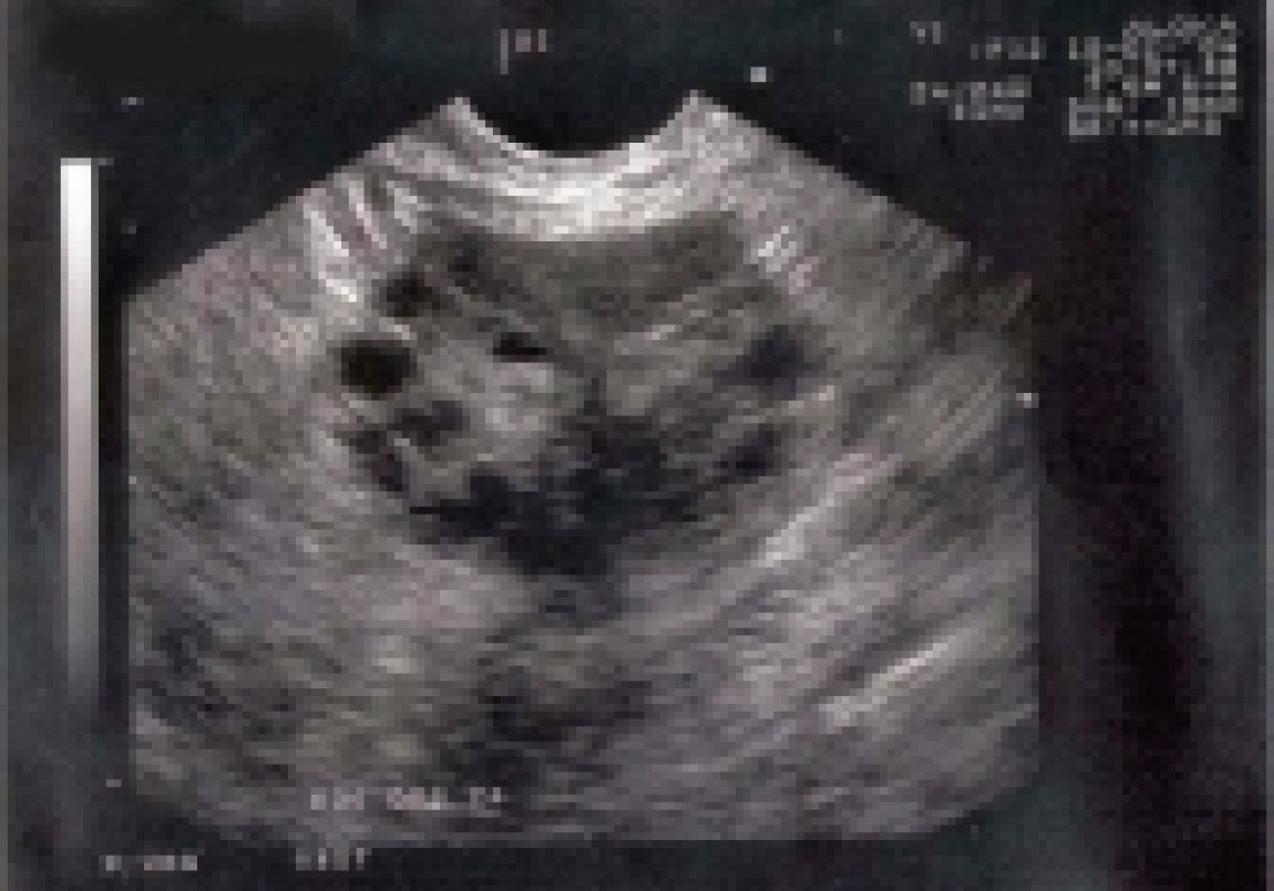 Poly Cysteus Ovarium Syndroom (PCOS) | St. Antonius Ziekenhuis