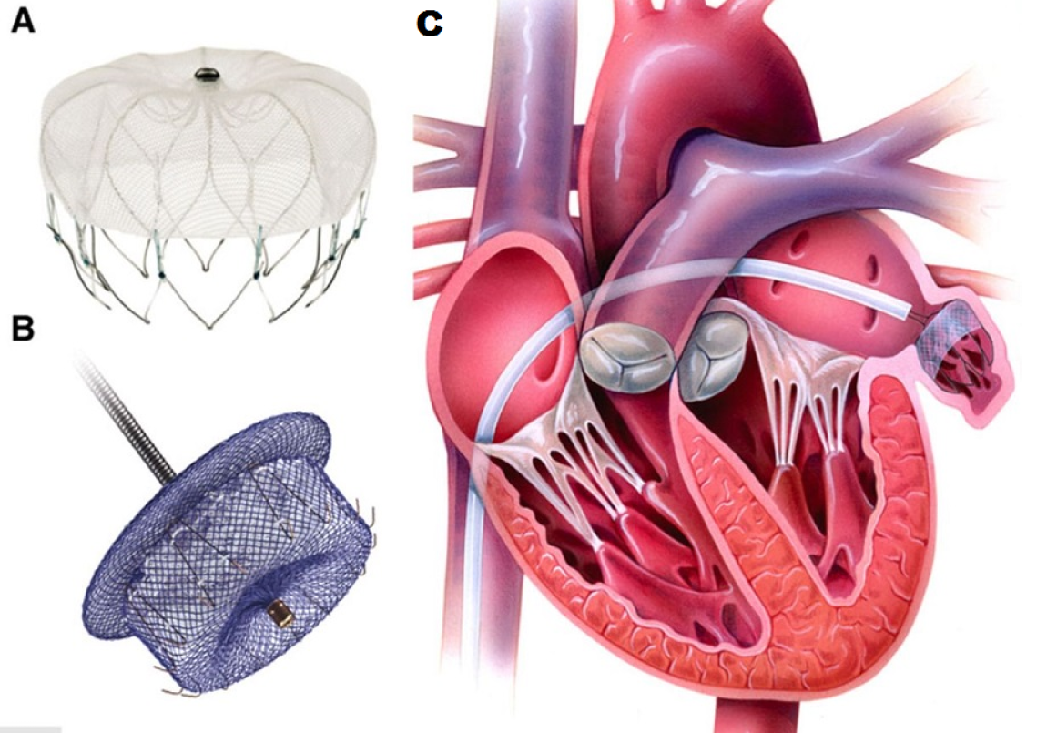 Linker hartoorsluiting (LAAO) | St. Antonius Ziekenhuis