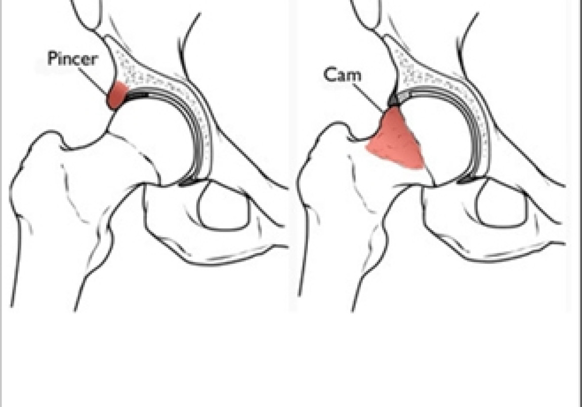 Impingement en/of labrumscheur van de heup | St. Antonius Ziekenhuis