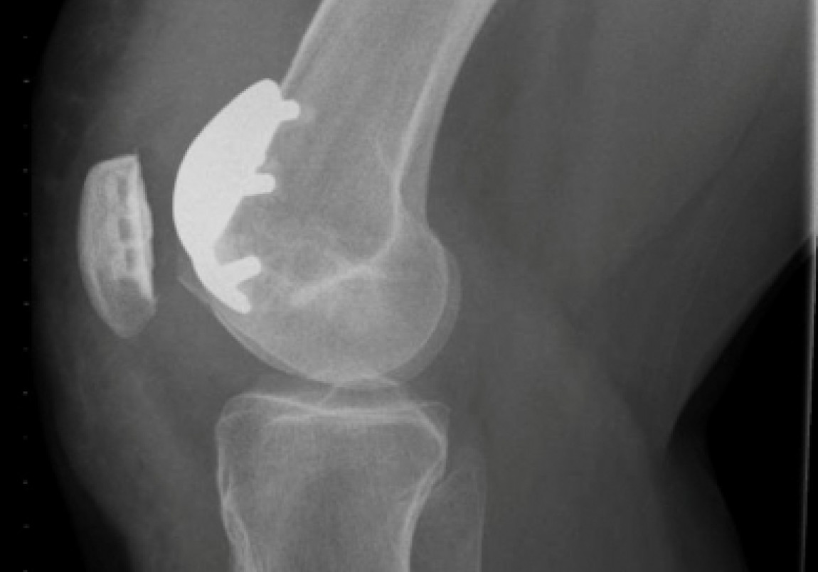 Knieschijfprothese (patellofemorale prothese) | St. Antonius Ziekenhuis