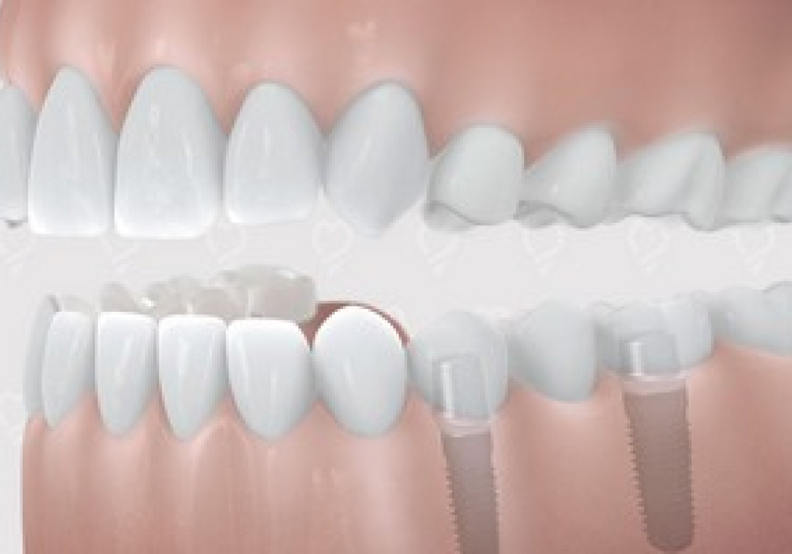 Tandwortelimplantaten | St. Antonius Ziekenhuis