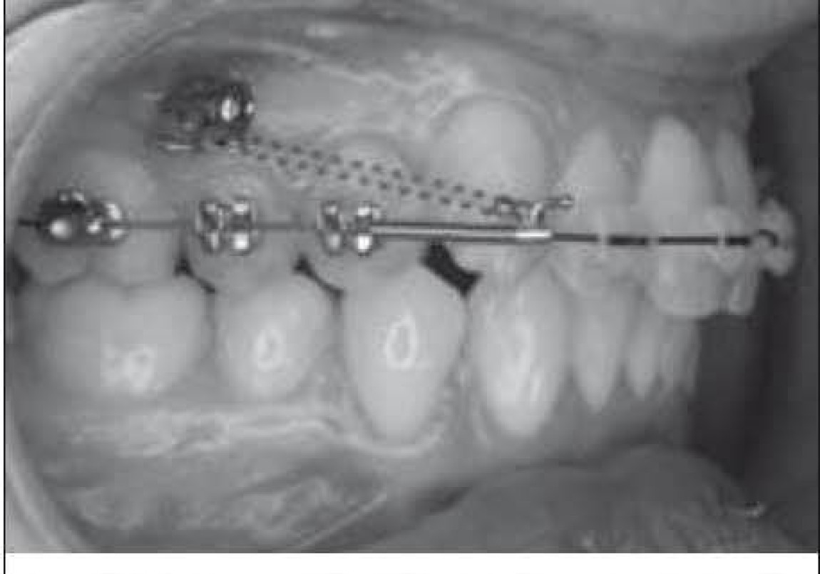 Botanker of orthodontisch schroefje plaatsen en verwijderen | St ...