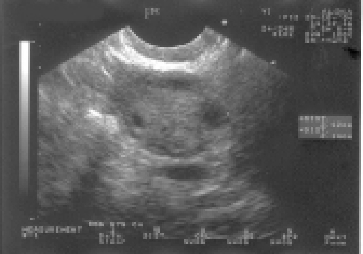 Poly Cysteus Ovarium Syndroom (PCOS) | St. Antonius Ziekenhuis