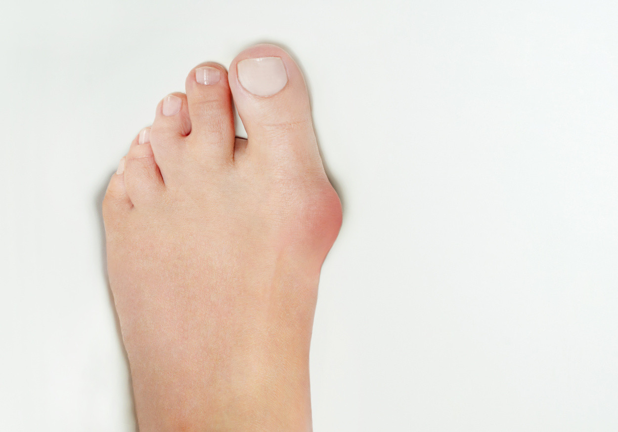 Hallux valgus - behandeling | St. Antonius Ziekenhuis