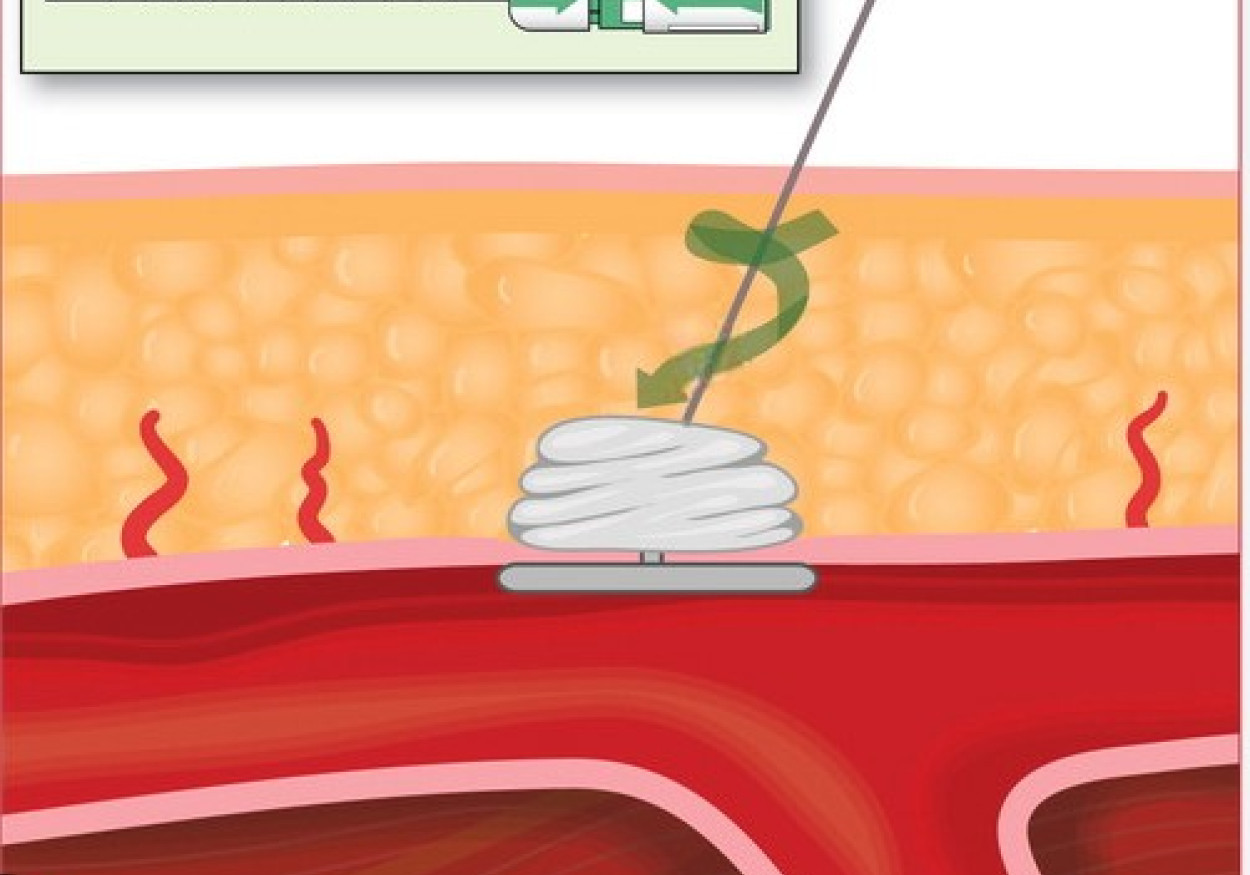 Omgaan met een angioseal na katheterisatie | St. Antonius Ziekenhuis