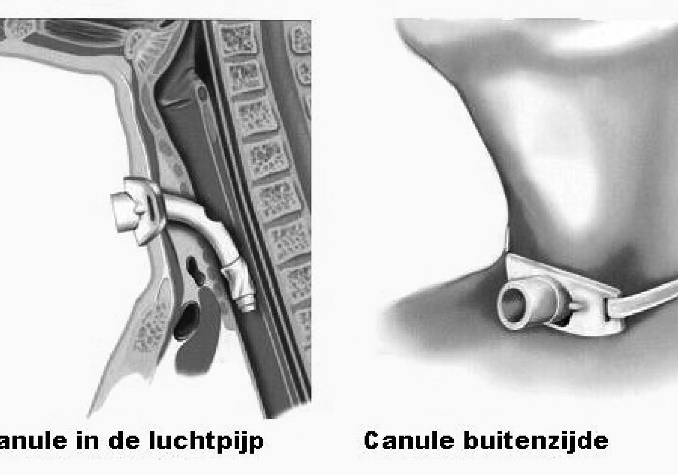 Tracheotomie op de Intensive Care | St. Antonius Ziekenhuis