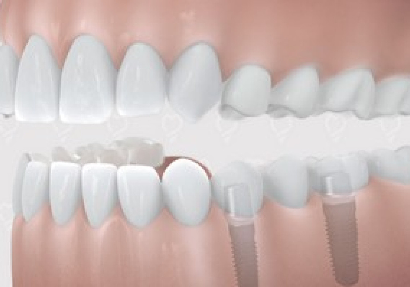 Tandwortelimplantaten | St. Antonius Ziekenhuis