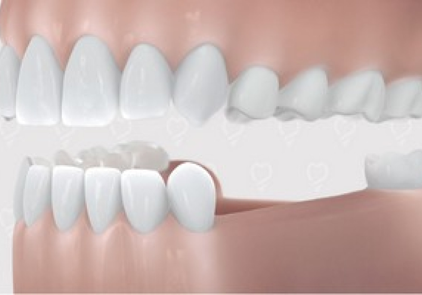 Tandwortelimplantaten | St. Antonius Ziekenhuis