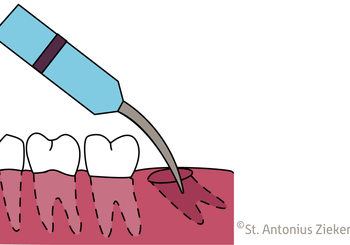 Nazorg na kaakchirurgische behandeling | St. Antonius Ziekenhuis