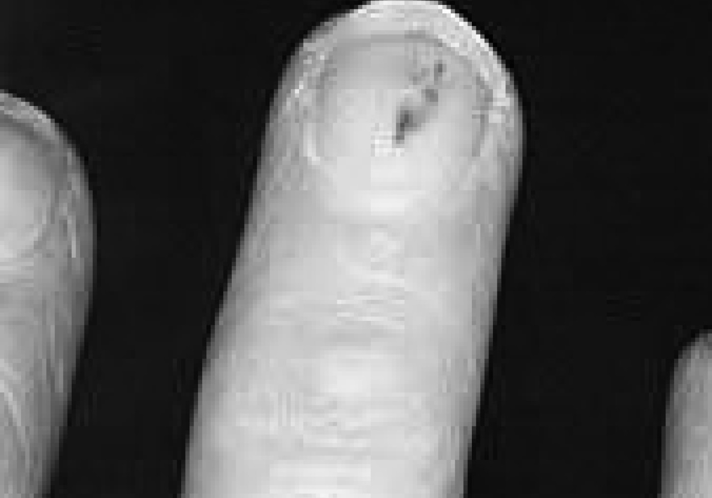 Bacteriële endocarditis | St. Antonius Ziekenhuis