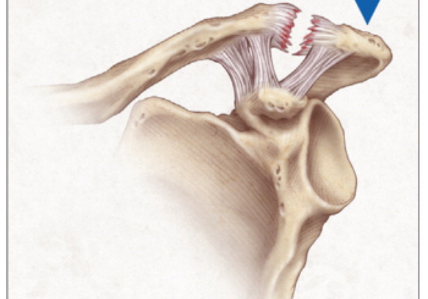 AC-luxatie (acromio claviculaire luxatie) | St. Antonius Ziekenhuis