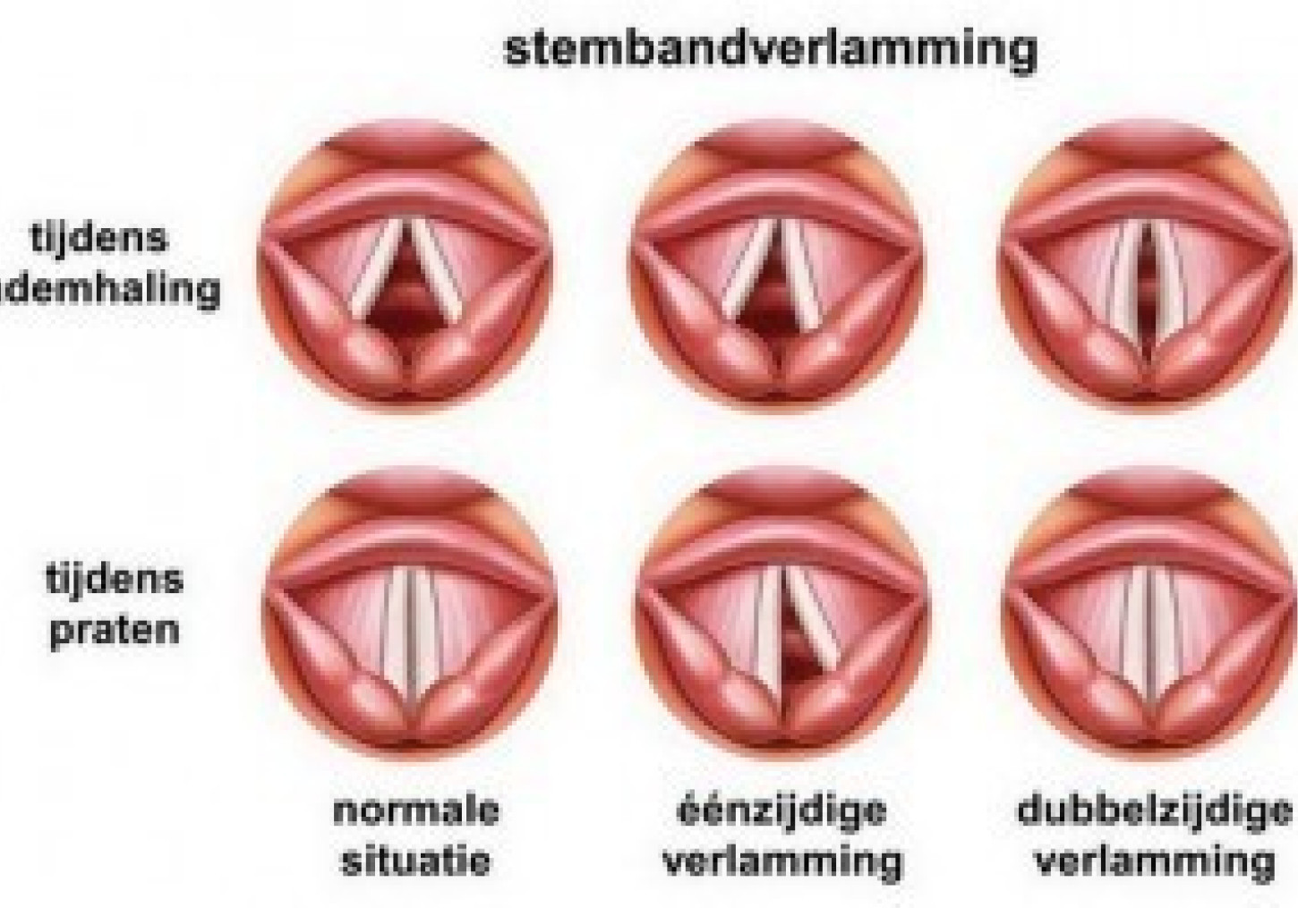 Stembandverlamming | St. Antonius Ziekenhuis