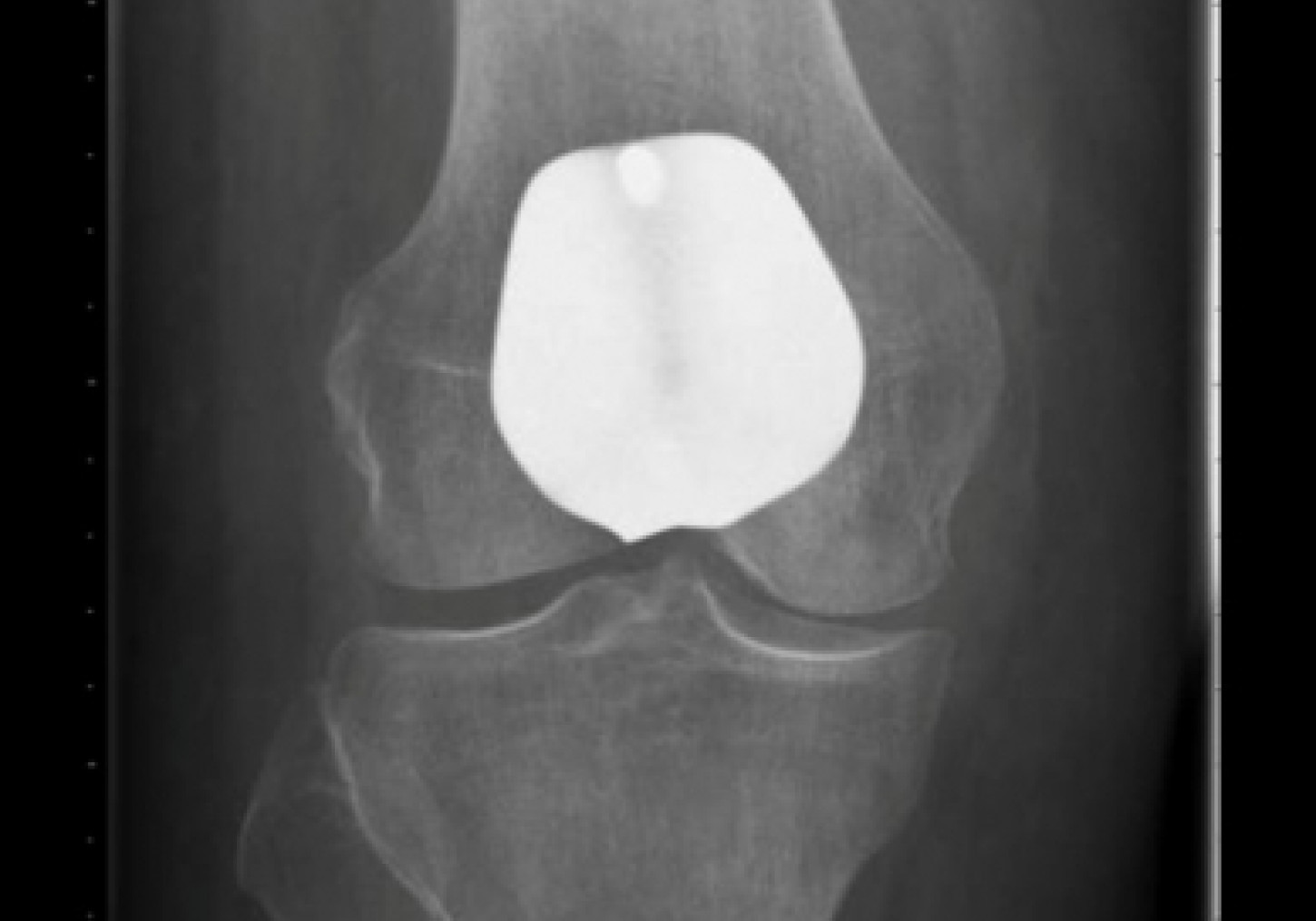 Knieschijfprothese (patellofemorale prothese) | St. Antonius Ziekenhuis