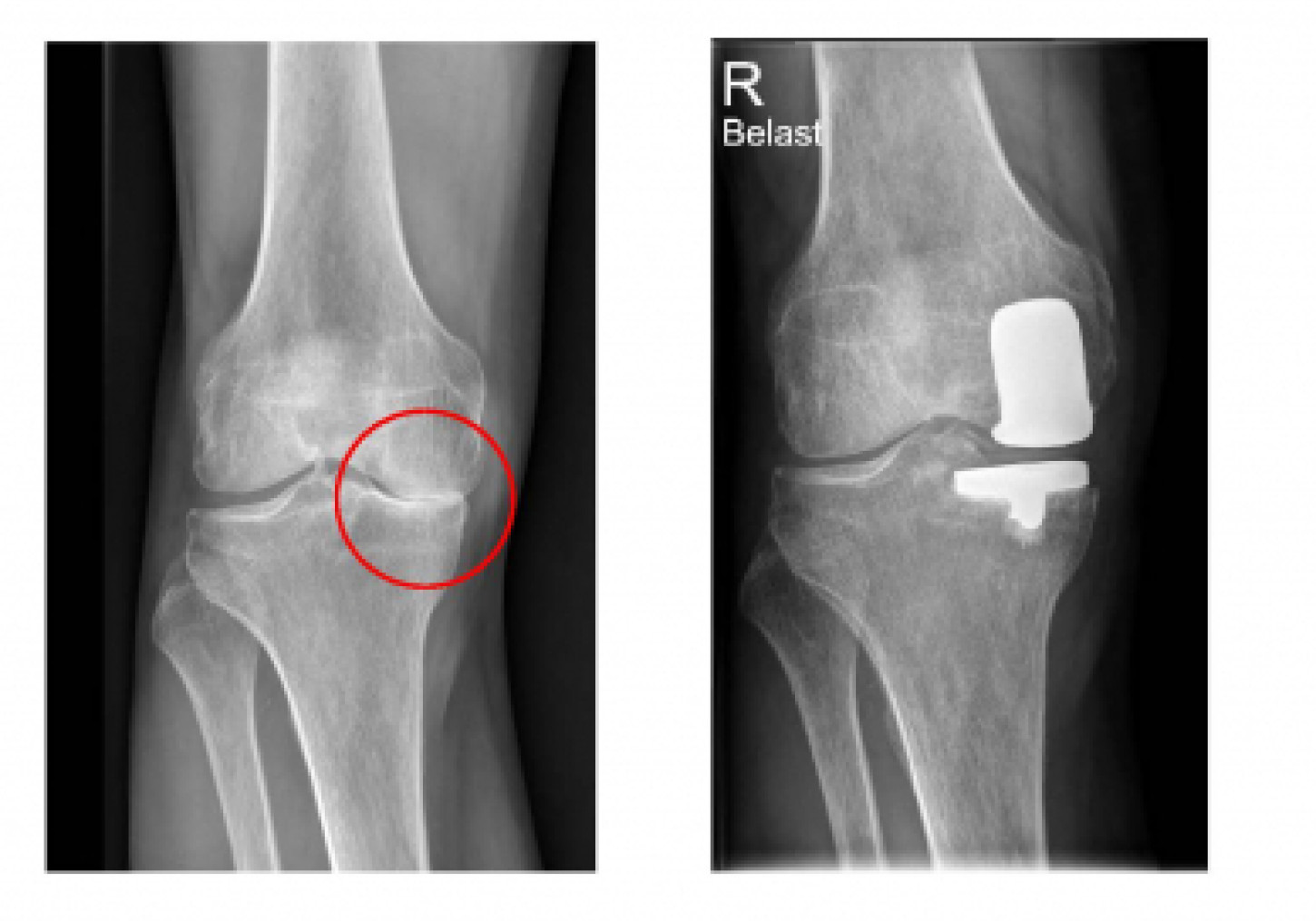 Unicondylaire knieprothese | St. Antonius Ziekenhuis