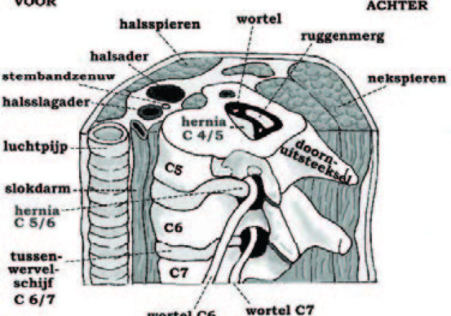 Wervel-, wortelkanaalvernauwing en nekhernia (operatie) | St. Antonius ...