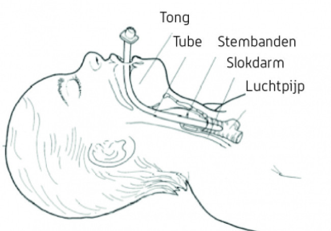 Beademing op de Intensive Care | St. Antonius Ziekenhuis