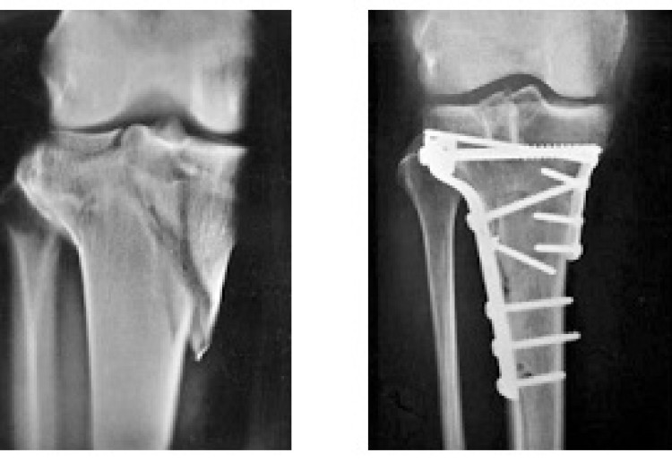 Fysiotherapie na een tibia plateau fractuur | St. Antonius Ziekenhuis