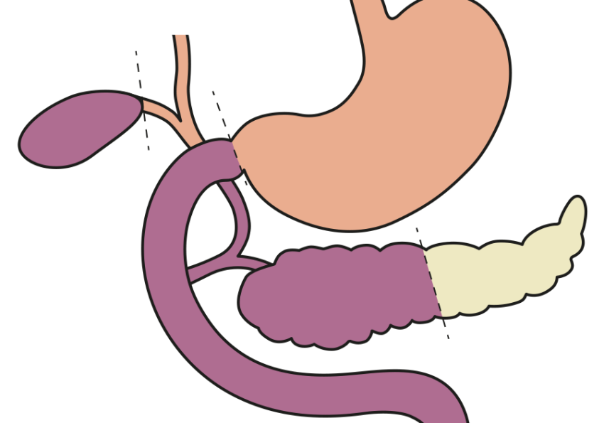 Alvleesklieroperatie | St. Antonius Ziekenhuis