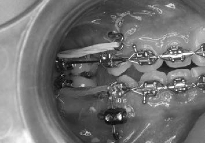 Botanker of orthodontisch schroefje plaatsen en verwijderen | St ...