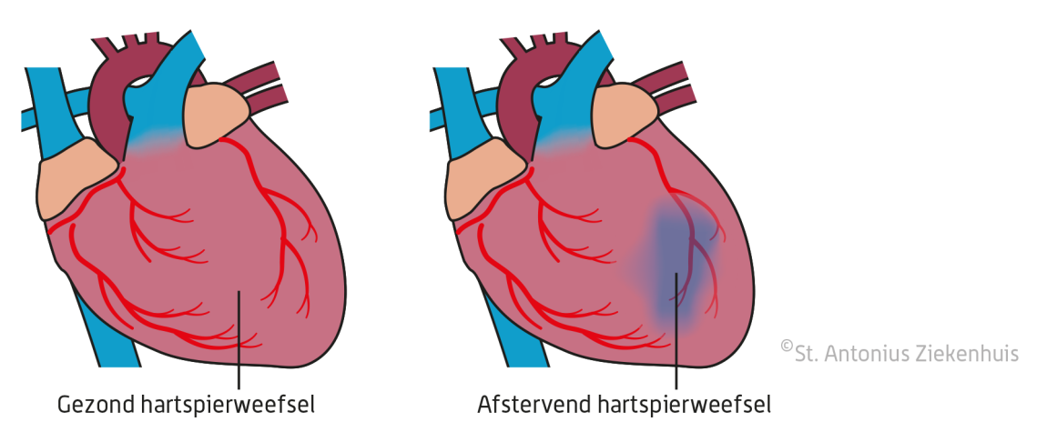 Hartinfarct (Myocardinfarct) | St. Antonius Ziekenhuis
