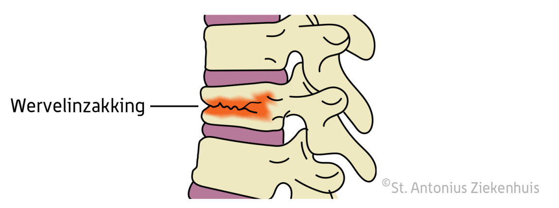 Osteoporose (botontkalking) | St. Antonius Ziekenhuis