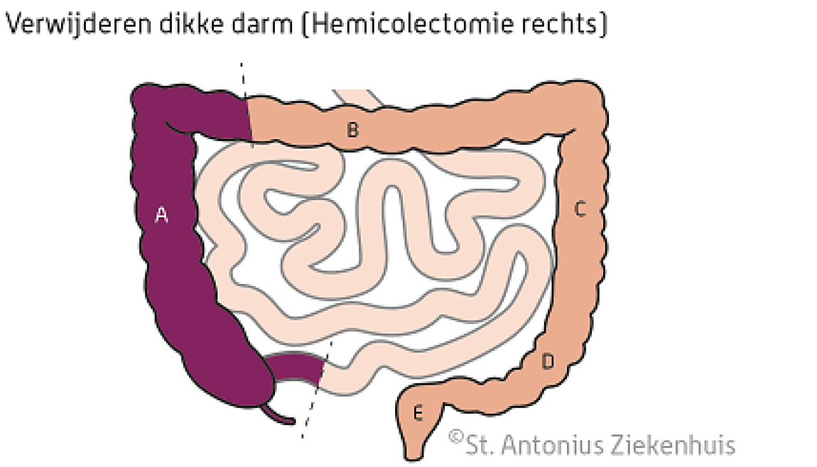 Darmoperatie | St. Antonius Ziekenhuis