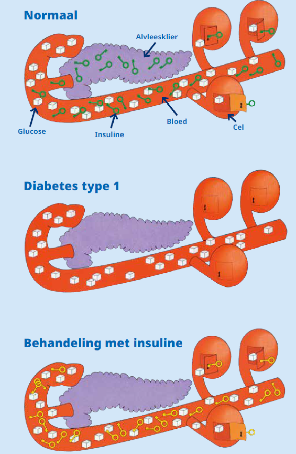 Diabetes mellitus type 1 | St. Antonius Ziekenhuis
