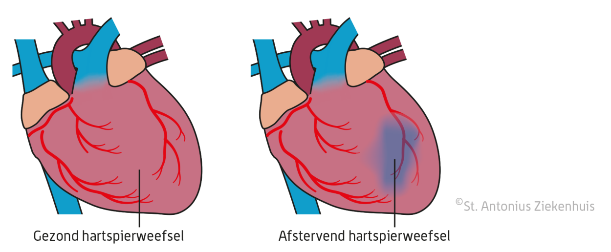 Hartinfarct (Myocardinfarct) | St. Antonius Ziekenhuis