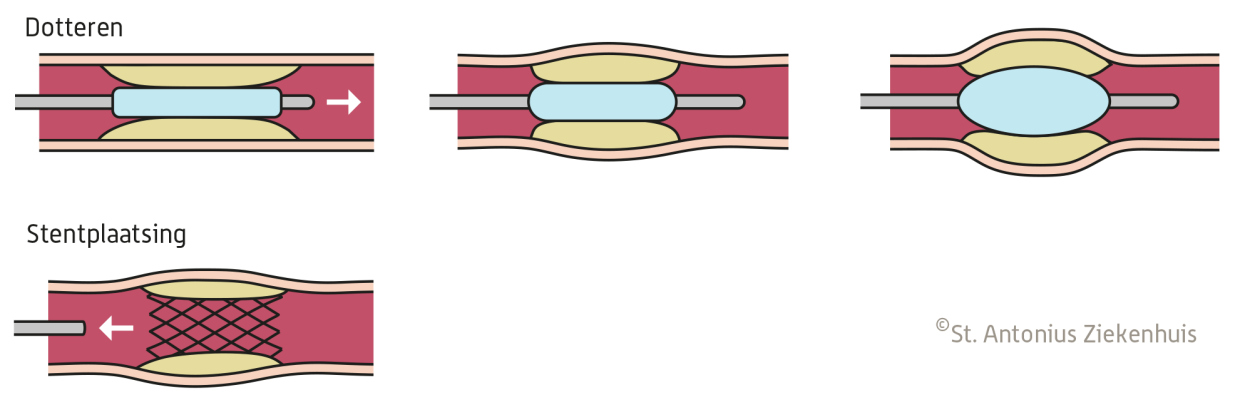 Dotterbehandeling (pci) | St. Antonius Ziekenhuis