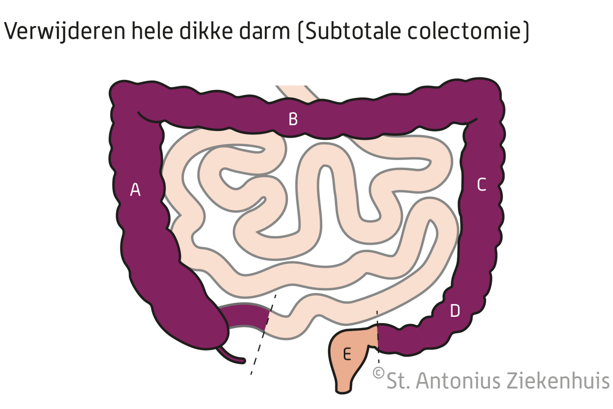 Darmoperatie | St. Antonius Ziekenhuis