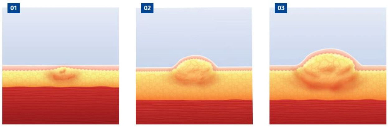 Insuline spuiten | St. Antonius Ziekenhuis