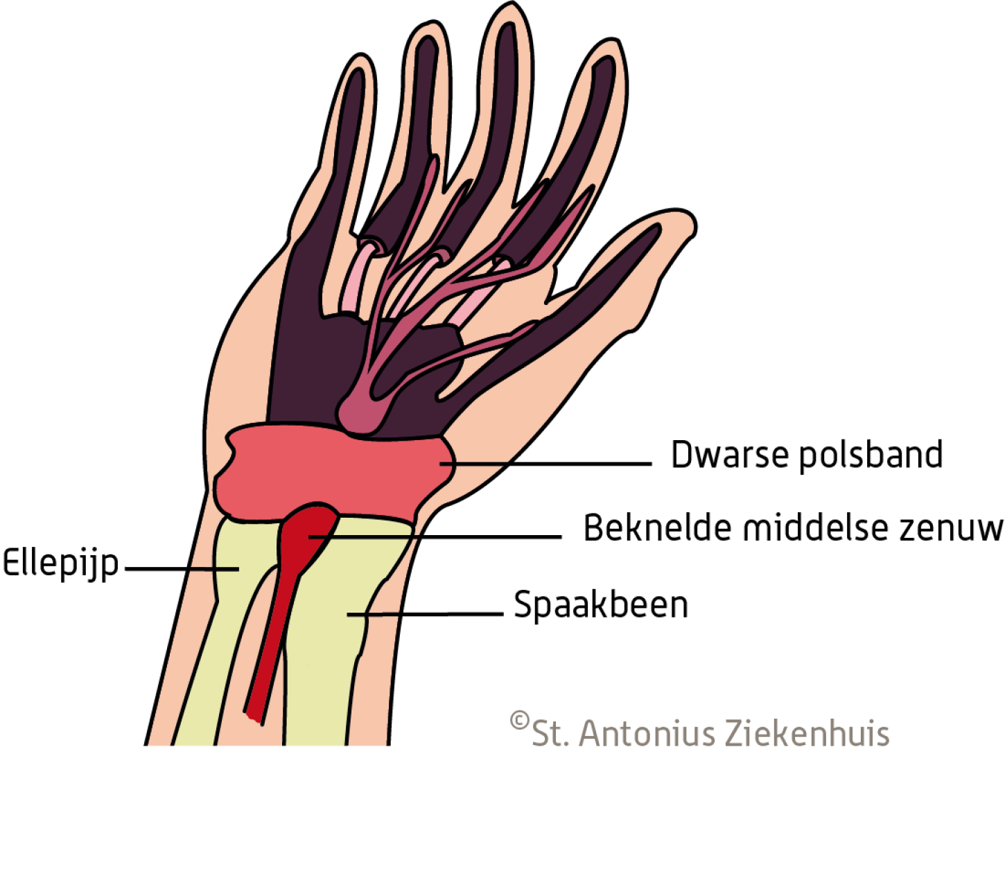 Carpale tunnelsyndroom (operatie) | St. Antonius Ziekenhuis