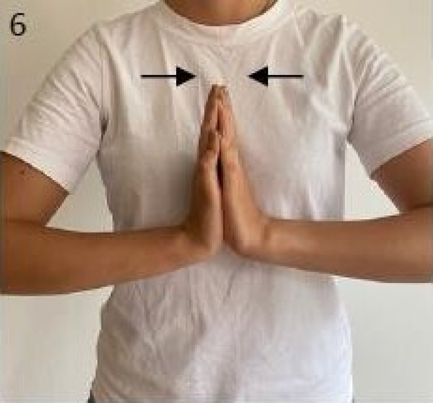 Dislocated collarbone | St. Antonius Ziekenhuis