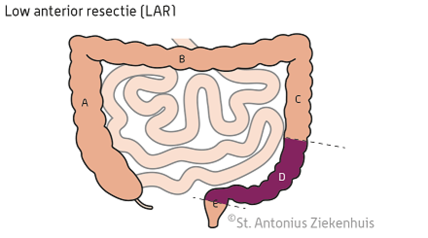 Darmoperatie | St. Antonius Ziekenhuis