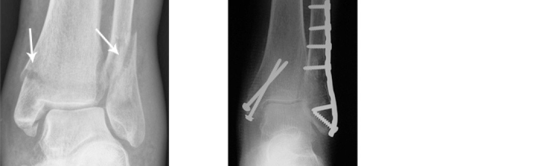 Fysiotherapie oefeningen na breuk van de enkel | St. Antonius Ziekenhuis