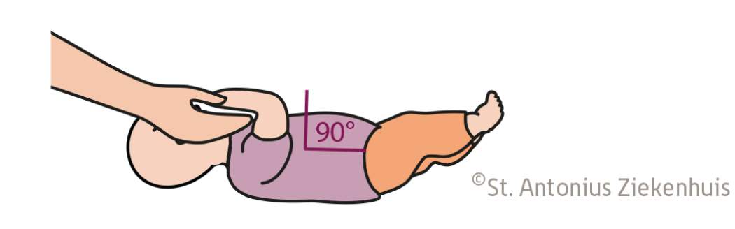 Baby geboren met een schouderdystocie en/of gebroken sleutelbeentje | St. Antonius Ziekenhuis