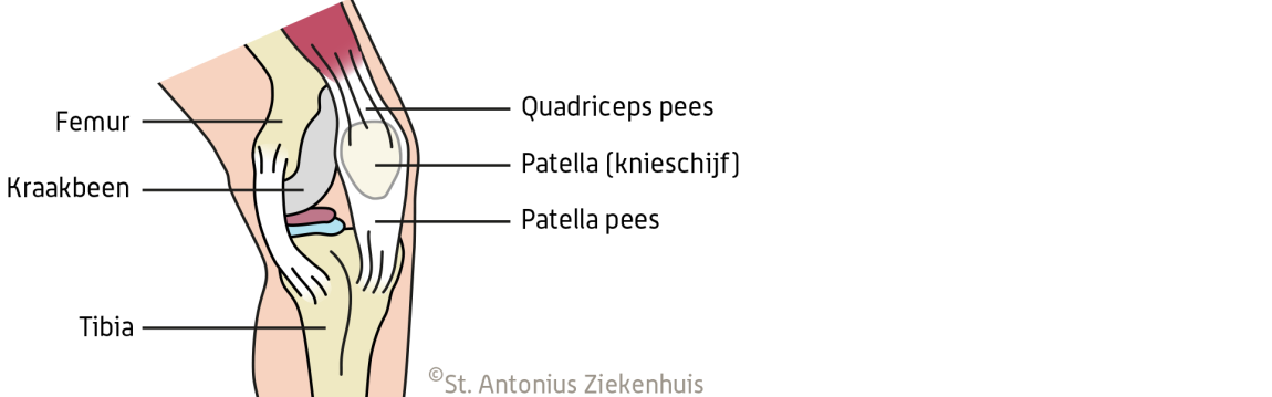 Patellaluxatie | St. Antonius Ziekenhuis