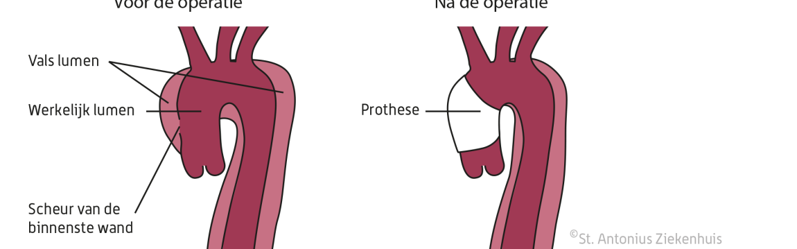 Aortadissectie type A - behandeling | St. Antonius Ziekenhuis
