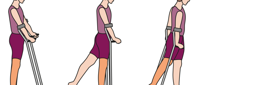 Oefenadvies na een hallux valgus operatie | St. Antonius Ziekenhuis