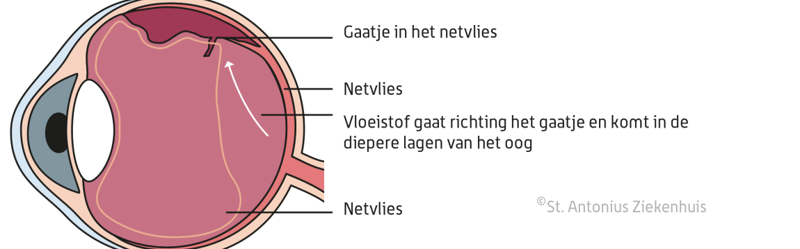 Netvliesloslating | St. Antonius Ziekenhuis