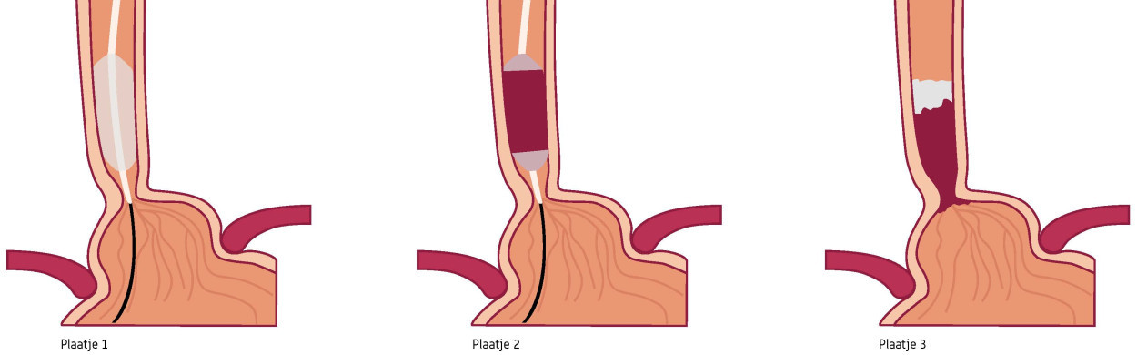 Barrett slokdarm: behandeling met radiofrequente ablatie | St. Antonius ...