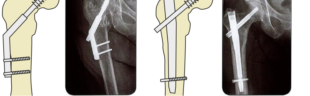Fysiotherapie na een heupfractuur | St. Antonius Ziekenhuis