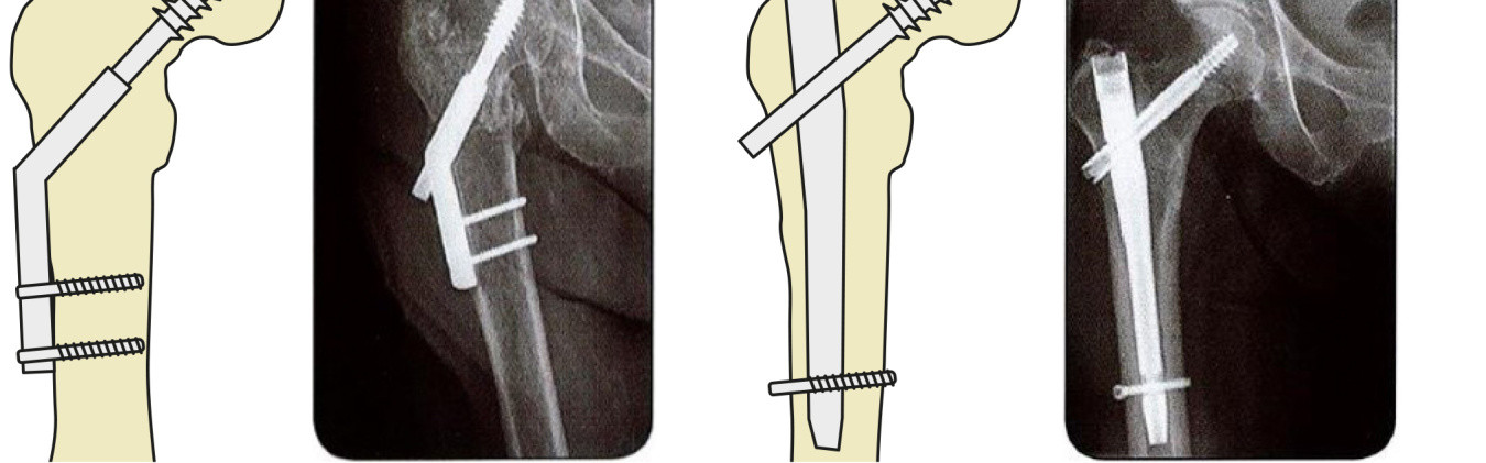 Fysiotherapie na een heupfractuur | St. Antonius Ziekenhuis