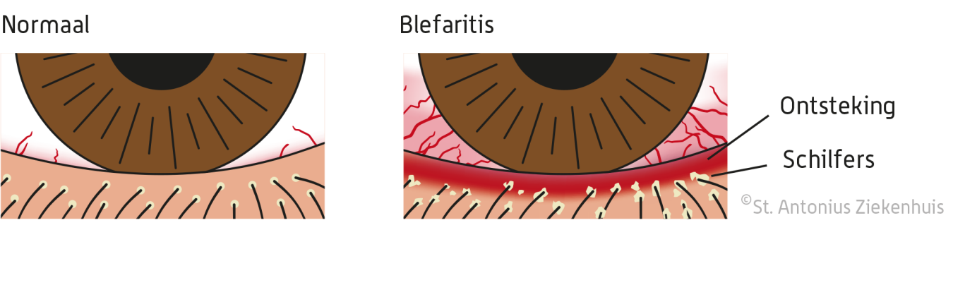 Blefaritis en Meibomklierdysfunctie | St. Antonius Ziekenhuis
