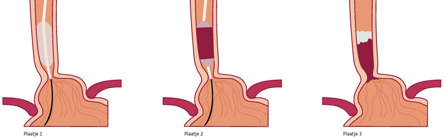 Barrett slokdarm: behandeling met radiofrequente ablatie | St. Antonius ...