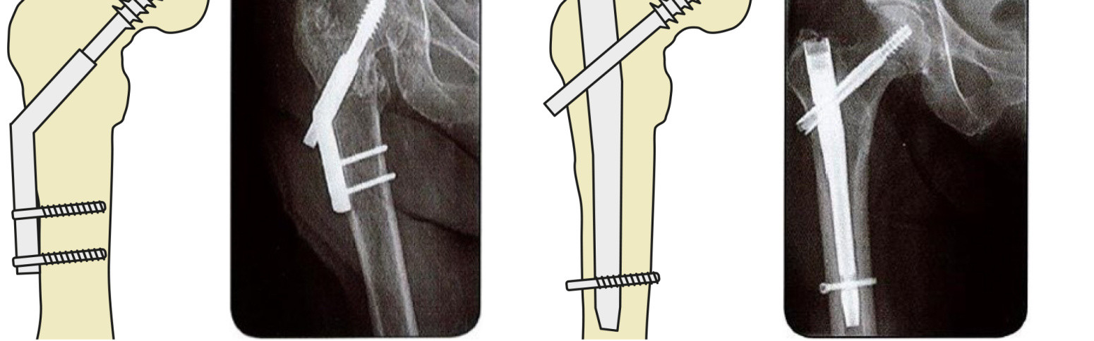 Fysiotherapie na een heupfractuur | St. Antonius Ziekenhuis