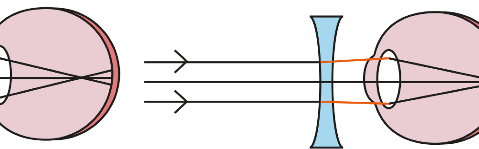 Progressieve myopie: behandeling met Atropine | St. Antonius Ziekenhuis
