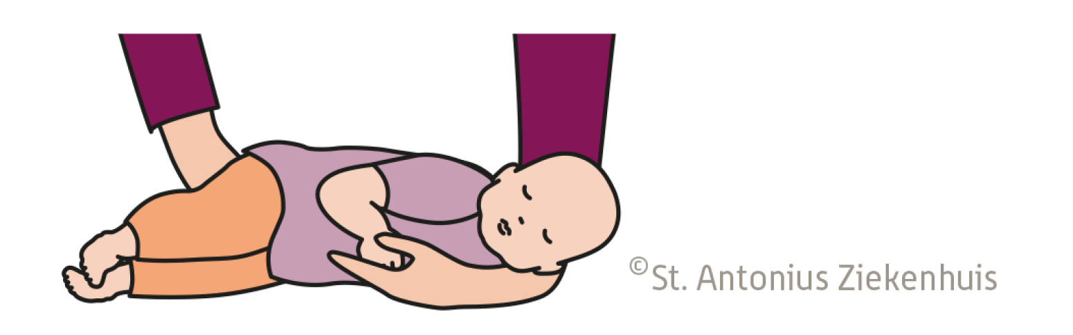 Baby geboren met een schouderdystocie en/of gebroken sleutelbeentje | St. Antonius Ziekenhuis